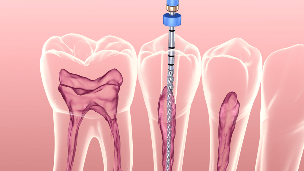 Endodontic Services | Dr. Yage Wu, DDS in Edison, NJ